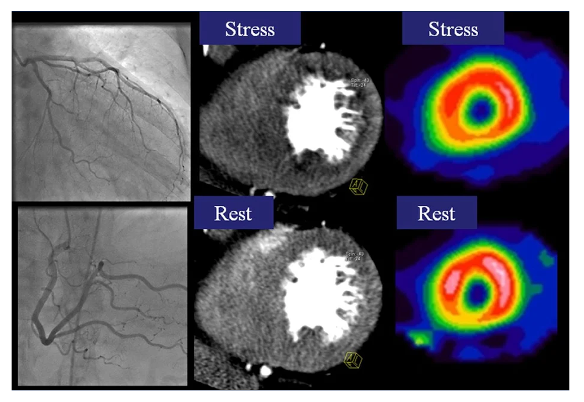How To Read Myocardial Perfusion Scan at Aiden Ligar blog